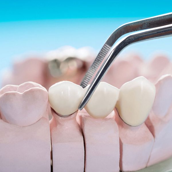 Gigi Palsu Murah Berkualitas - Pasang Gigi Tiruan di Dokter Gigi