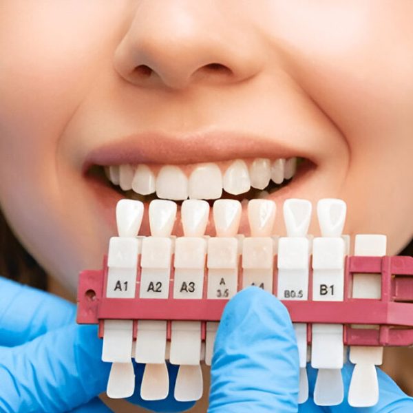 Veneer Gigi: Solusi Estetik untuk Senyum Cerah - Sozo Dental